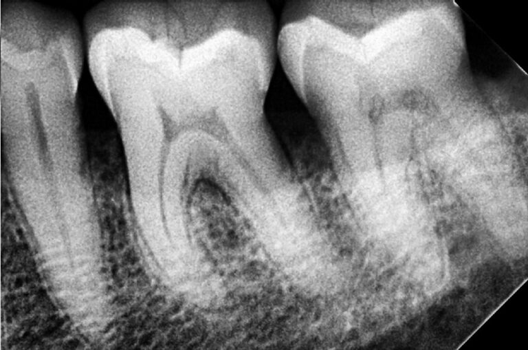 Painless Extraction – Finesse Dental